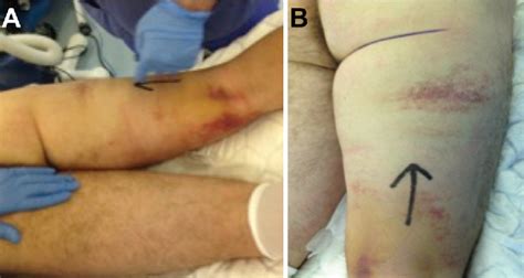 Figure 1 From Timing Of Surgery For Complete Proximal Hamstring