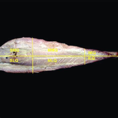 Simultaneous Termination Of The Soleus Vein Into The Medial And Lateral