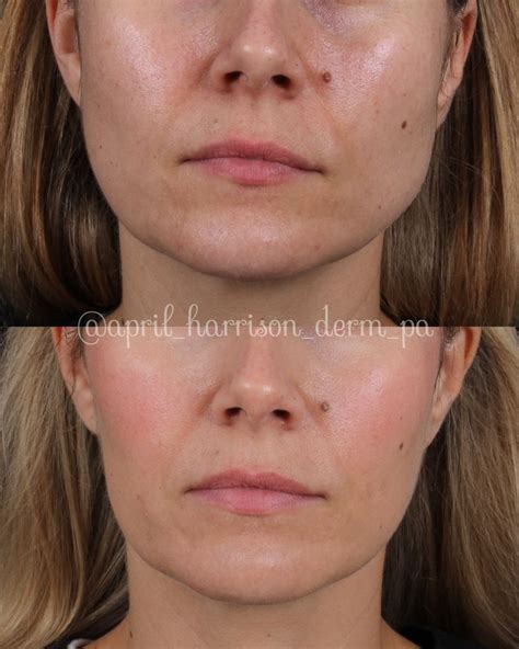 Pin On Botox Injections