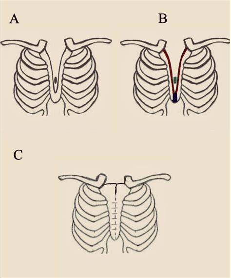 Muhammad Taimour Khan Md On Linkedin Medicalillustration Sternalcleft Learningbydoing
