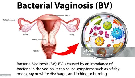 Bacterial Vaginosis Infographic With Explanation Stock Illustration Download Image Now Istock