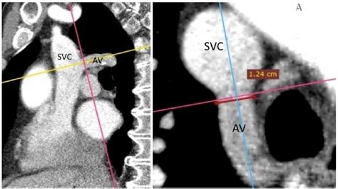 Measurement Point Of The Azygos Vein Av Diameter At The Av—svc