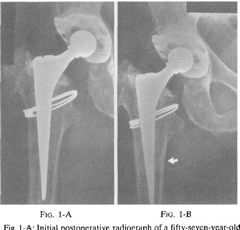 Figure 1 From Impaction Bone Grafting Before Insertion Of A Femoral