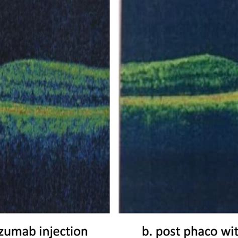 Subtenon Triamcinolone Acetonide Injection A Preoperative B After Download Scientific Diagram