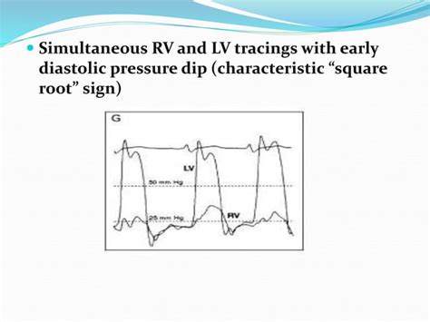 Chronic Constrictive Pericarditis Pptx