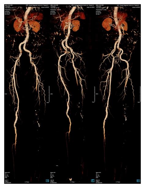 Ct Angiogram Lower Limb Abdur Rahman Himel