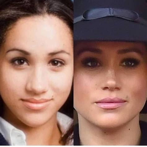 Meghan Markle Nose Job Celebrity Botox Before And After Face Plastic