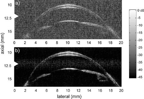 Figure 1 From High Frequency Ultrasonic Imaging Of The Anterior Segment