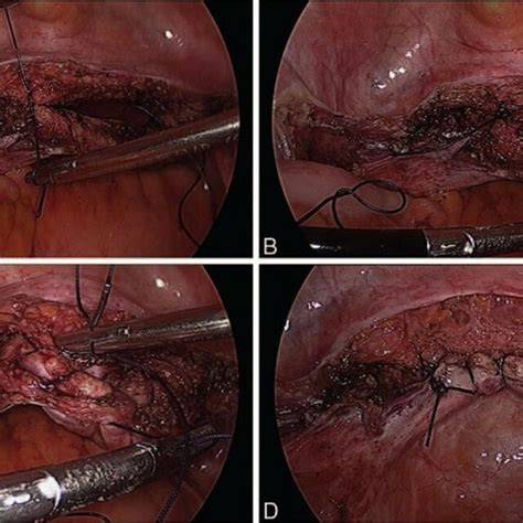 Vaginal Cuff Closure With Vicryl Suture A The Repair Was Started Download Scientific Diagram