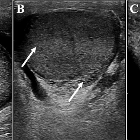 Significant Improvement Of Epididymitis In A B And C Arrows Only Download Scientific