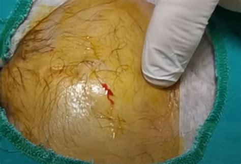 Infected Pilonidal Cyst Incision And Drainage New Pimple Popping Videos