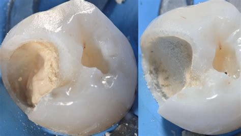 Direct Pulp Capping With Biobulk Technique
