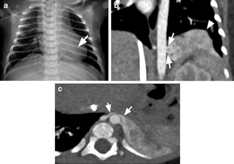 Extralobar Bronchopulmonary Sequestration Detected On Prenatal Imaging Download Scientific