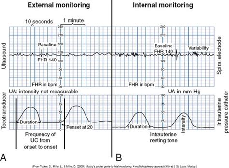 nurs 326 fetal heart rate patterns flashcards quizlet