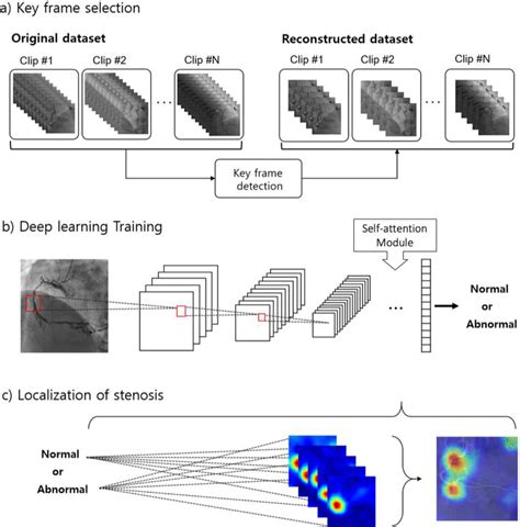 Overview Of The Framework For The Automated Recognition Of Stenosis On