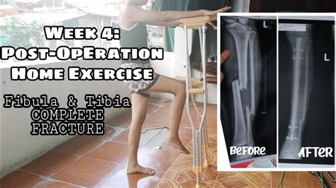 Week 4 Home Exercises Fibula And Tibia Complete Fracture Marjoe Yt