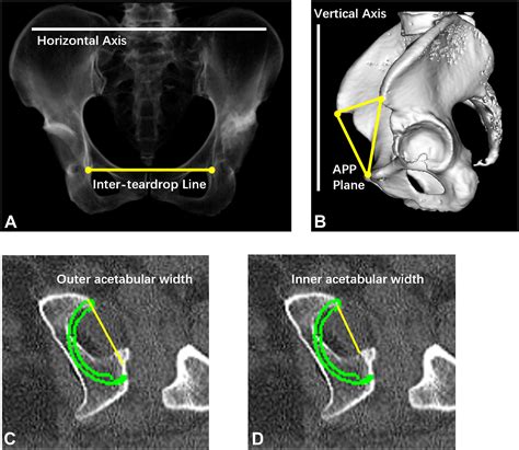 Acetabular Diameter Assessment And Three Dimensional Simulation For Acetabular Reconstruction In