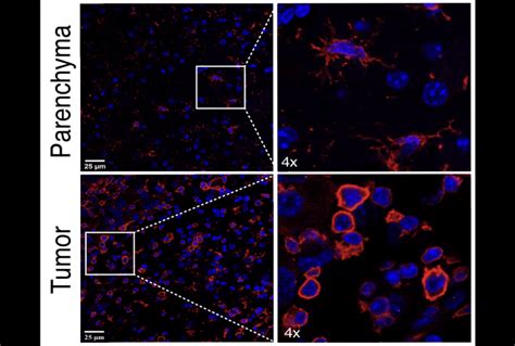 Immunometabolic Regulation Of Macrophages In Glioblastoma Inrs