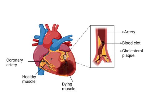 Advancements In Artificial Intelligence For Precision Diagnosis And Treatment Of Myocardial