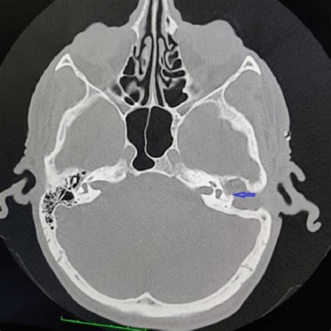 High Resolution Computed Tomography Scan Image Figure 1 Depicts The Download Scientific Diagram