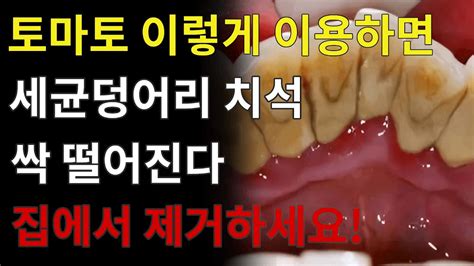 집에 토마토가 있다면 이렇게 하세요 잇몸뼈를 녹일 수 있는 치석돈 들이지 않고 집에서 제거할 수 있습니다토마토만 있으면