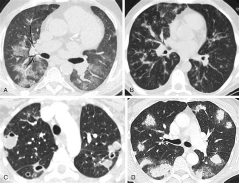 Approach To Diffuse Lung Disease Anatomic Basis And High Resolution Computed Tomography