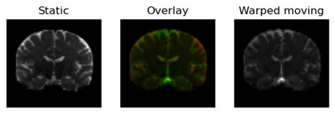 Symmetric Diffeomorphic Registration In 3d — Dipy 1110 Documentation