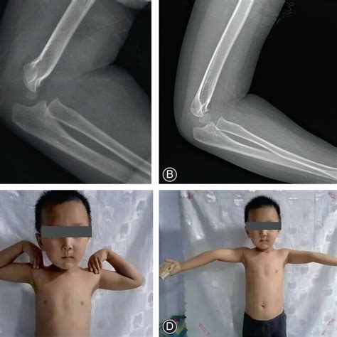 Illustration Of Fracture Angulation In The Sagittal Plane A D Download Scientific Diagram