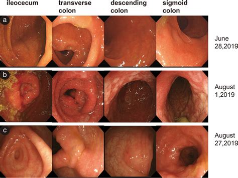 Colonoscopy Ascending Colon Experience Of Surgical Treatment In A