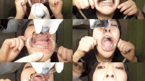 Removing Braces 101 Part 4 High Resolution Deviant Dentist Mouth