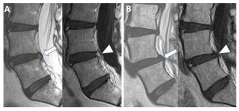 Long Term Follow Up Of Lumbar Spine Annular Fissures