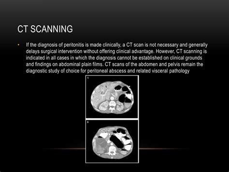 Ppt Acute Peritonitis Powerpoint Presentation Free Download Id6064315