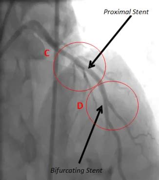 First Human Trial Advanced Bifurcation Systems