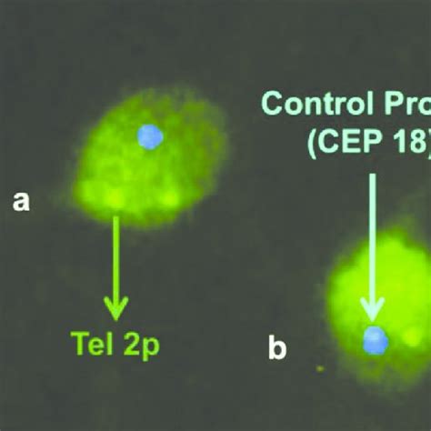 Paracentric Inversion Showing The Breakpoints On Chromosome 2 Figure