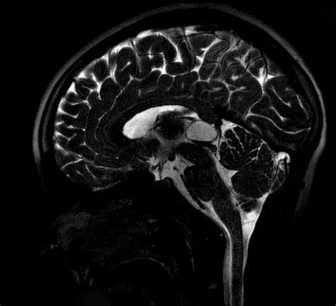 Ciss Sequence Mri Ars Neurochirurgica