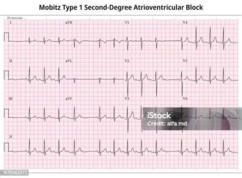 Mobitz Type 1 Second Degree Atrioventricular Block Ecg Paper 12 Lead