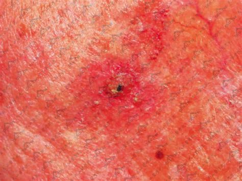 光线性角化病(老年日光性角化病)症状、诊断治疗参考 皮肤病学 天山医学院 光线性角化病(老年日光性角化病)症状、诊断治疗参考 皮肤病学 天山医学院