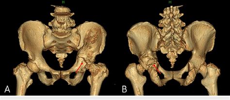 3 D Ct Of The Pelvis At Our Hospital Pseudarthrosis Of The Download Scientific Diagram