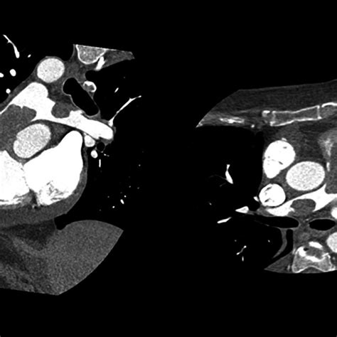 Cardiac Computed Tomography Reconstructions Showing The Two Masses Download Scientific Diagram