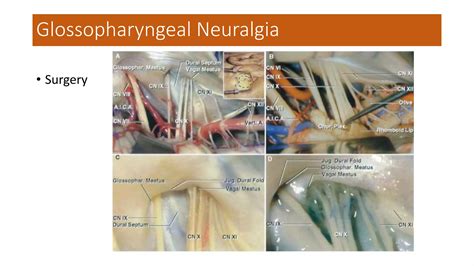 Microvascular Decompression Pptx