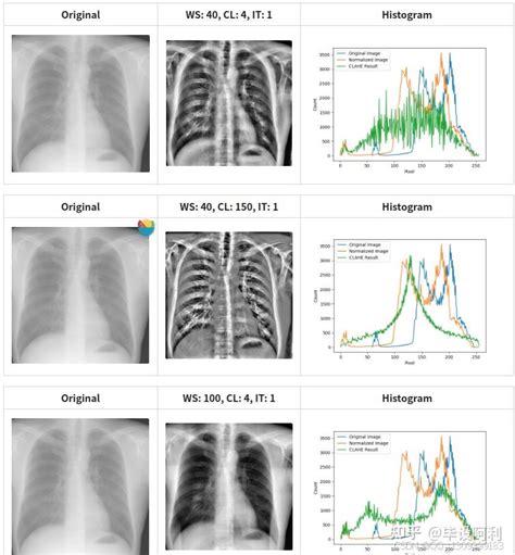 医学图像处理 X射线图像增强 对比度限制自适应直方图均衡化（clahe）、非锐化掩模（um）和高频强调滤波（hef） 知乎