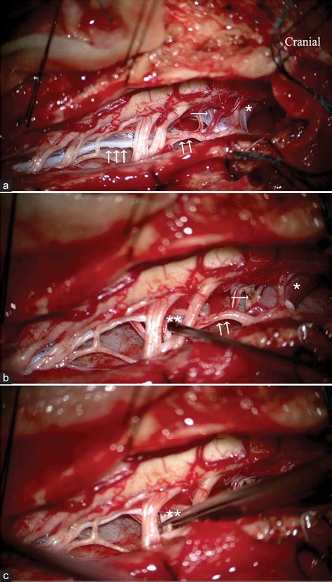 Modified Mckenzie Dandy Operation For A Cervical Dystonia Patient Who Failed Selective