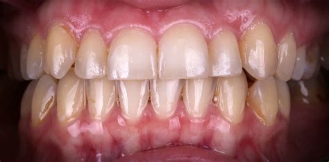 Home My Line Aligner