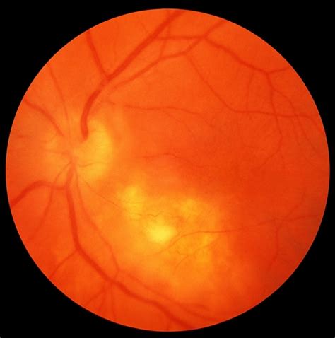 Toxoplasmosis Chorioretinitis Retina Image Bank