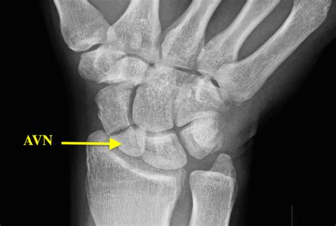 Fracture Scaphoid Hand Surgery Resource