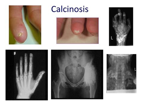 Ppt Calcinosis Working Group Update Powerpoint Presentation Free