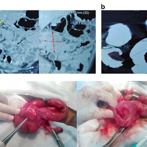 A Abdominal Ct Scan Showing Ileocolic Intussusception Yellow Arrow
