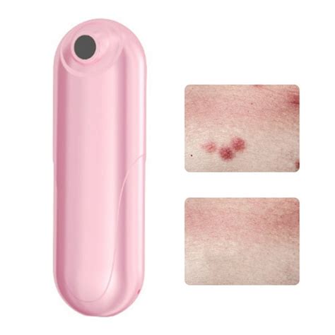 Bug Bite Itch Relief Tool Usb Rechargeable Mosquito Bite Sucker
