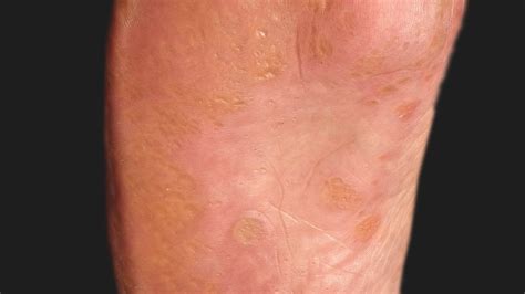 Punctate Keratosis