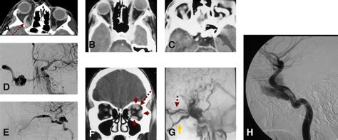 Carotid Cavernous Sinus Fistula A C Axial Enhanced Ct D Ap